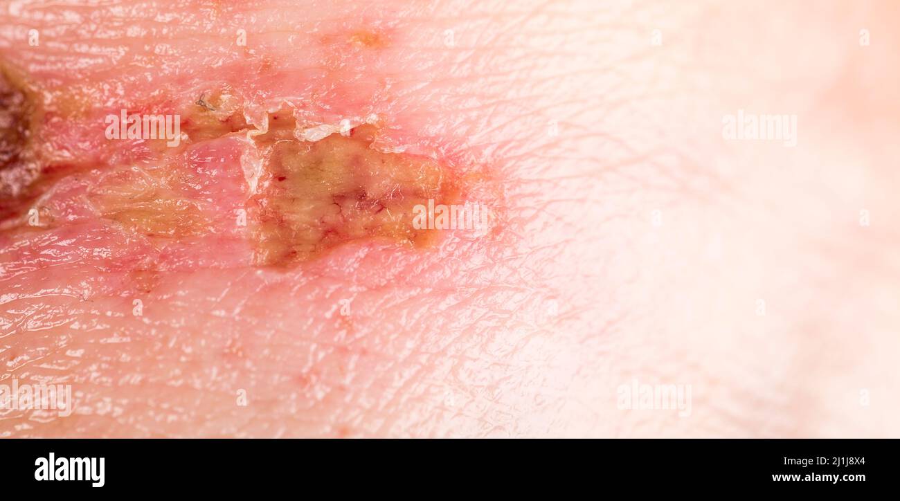 chemical burn on the wrist skin with hydroxide sodium acid, by striping ...
