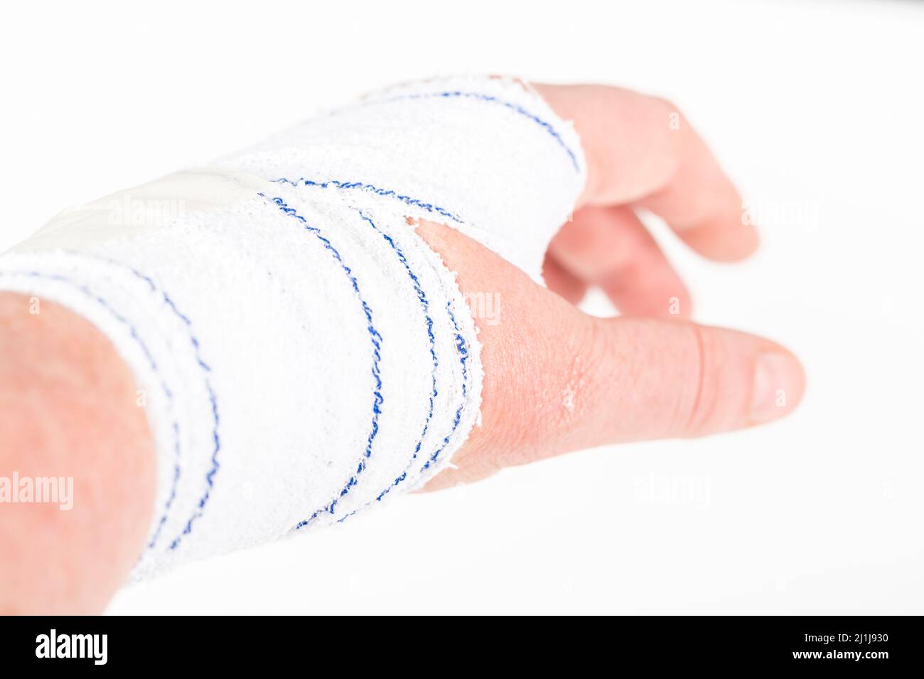 chemical burn on the wrist skin with hydroxide sodium acid. Festering ...