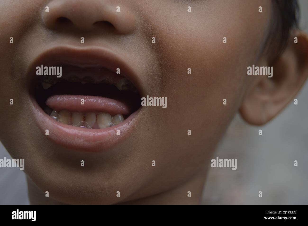 Boy with missing front teeth hi-res stock photography and images - Alamy