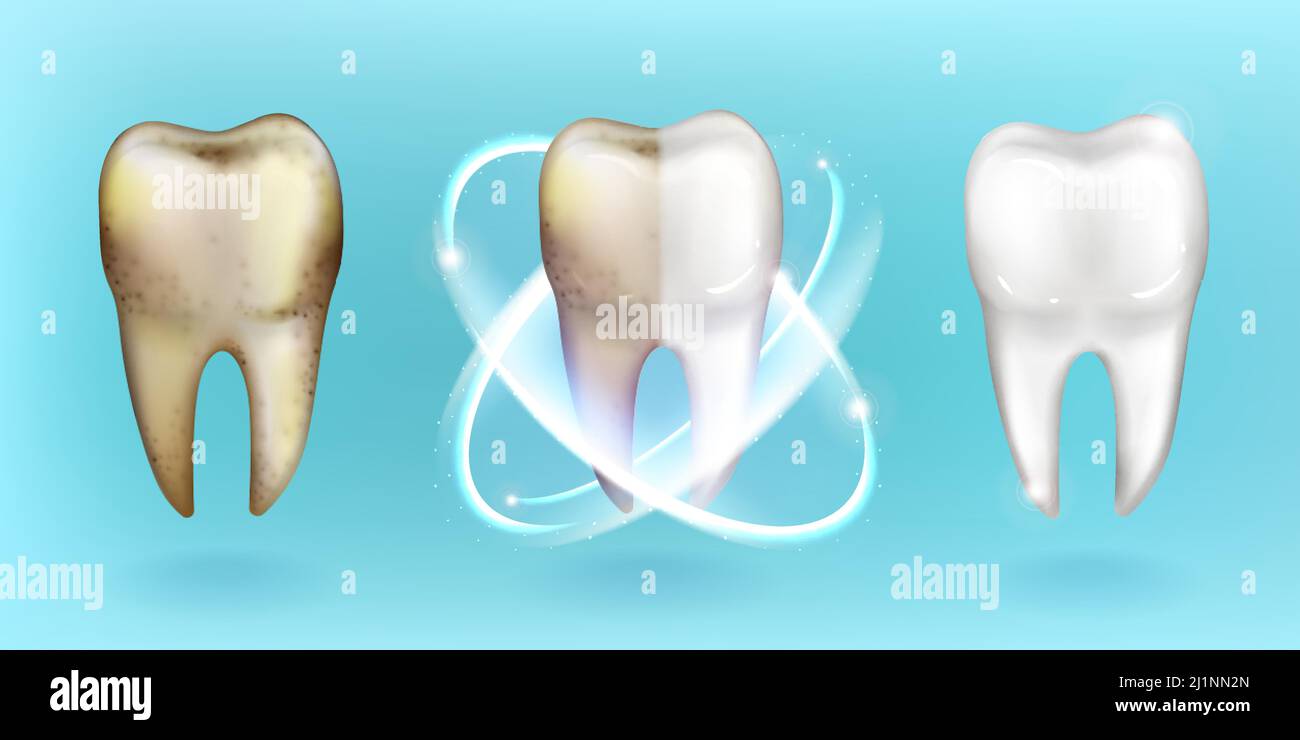 Clean and dirty tooth, whitening and clearing teeth process. Dental and ...