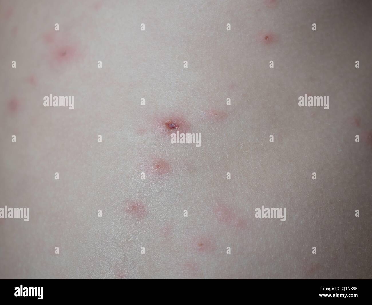 Chicken Pox Medicine