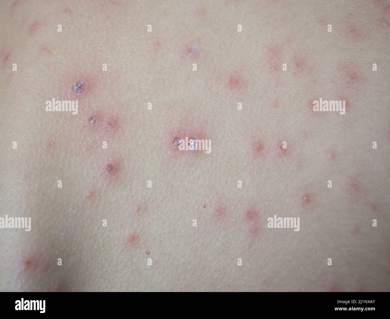Girl chicken pox hi-res stock photography and images - Alamy