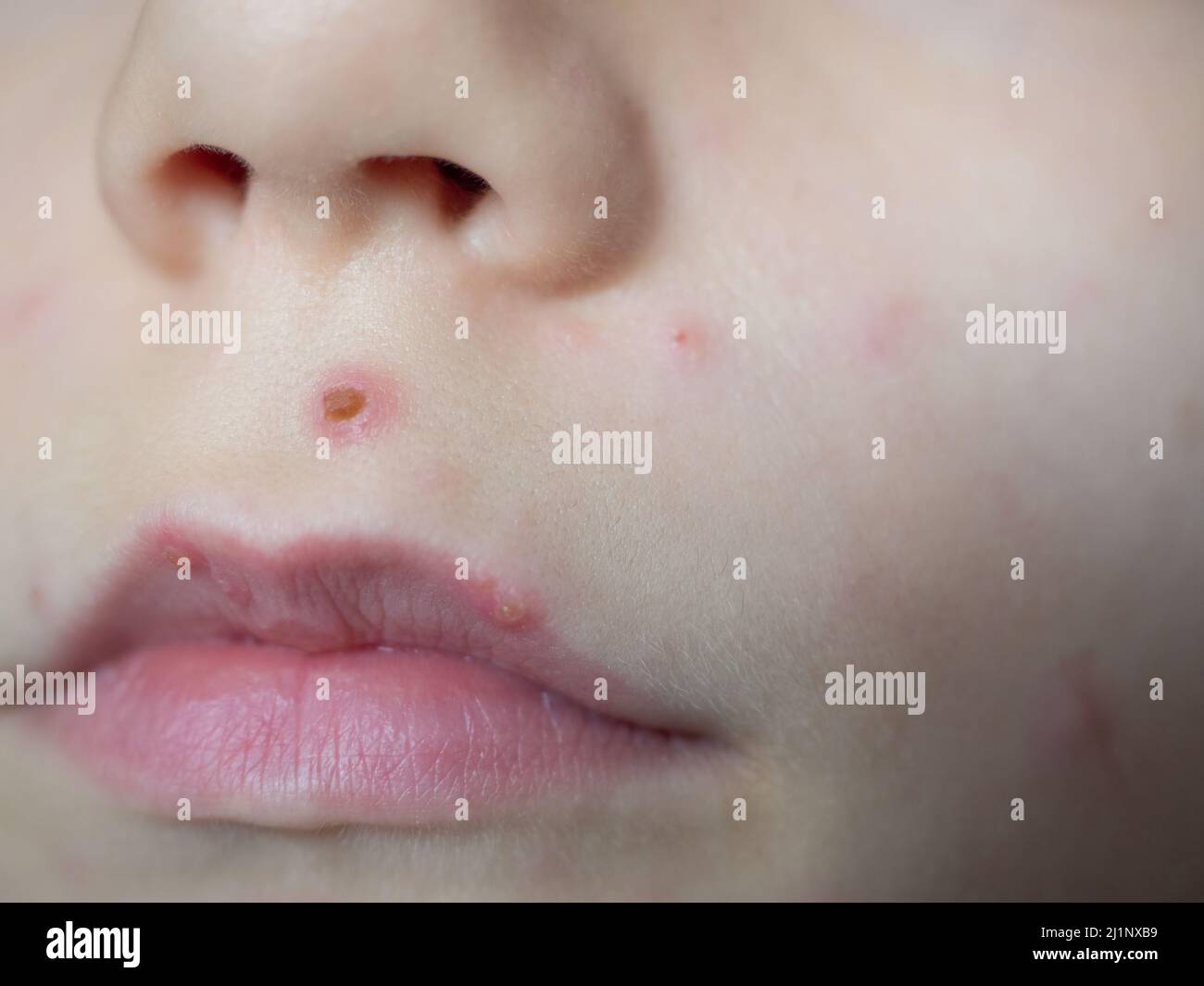 Skin ulcers hi-res stock photography and images - Alamy