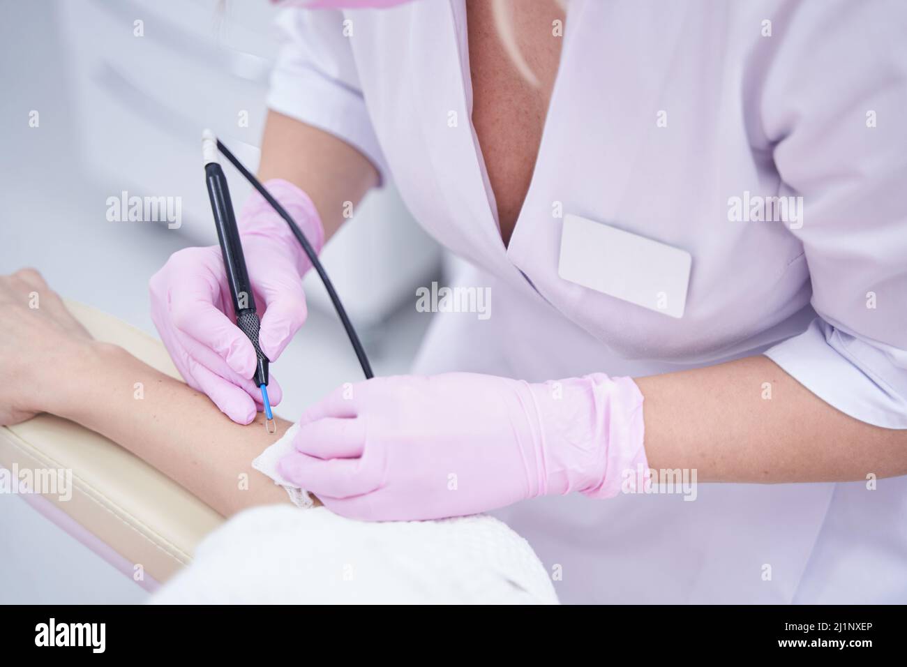 Experienced doctor excising nevus with wire loop electrode Stock Photo ...