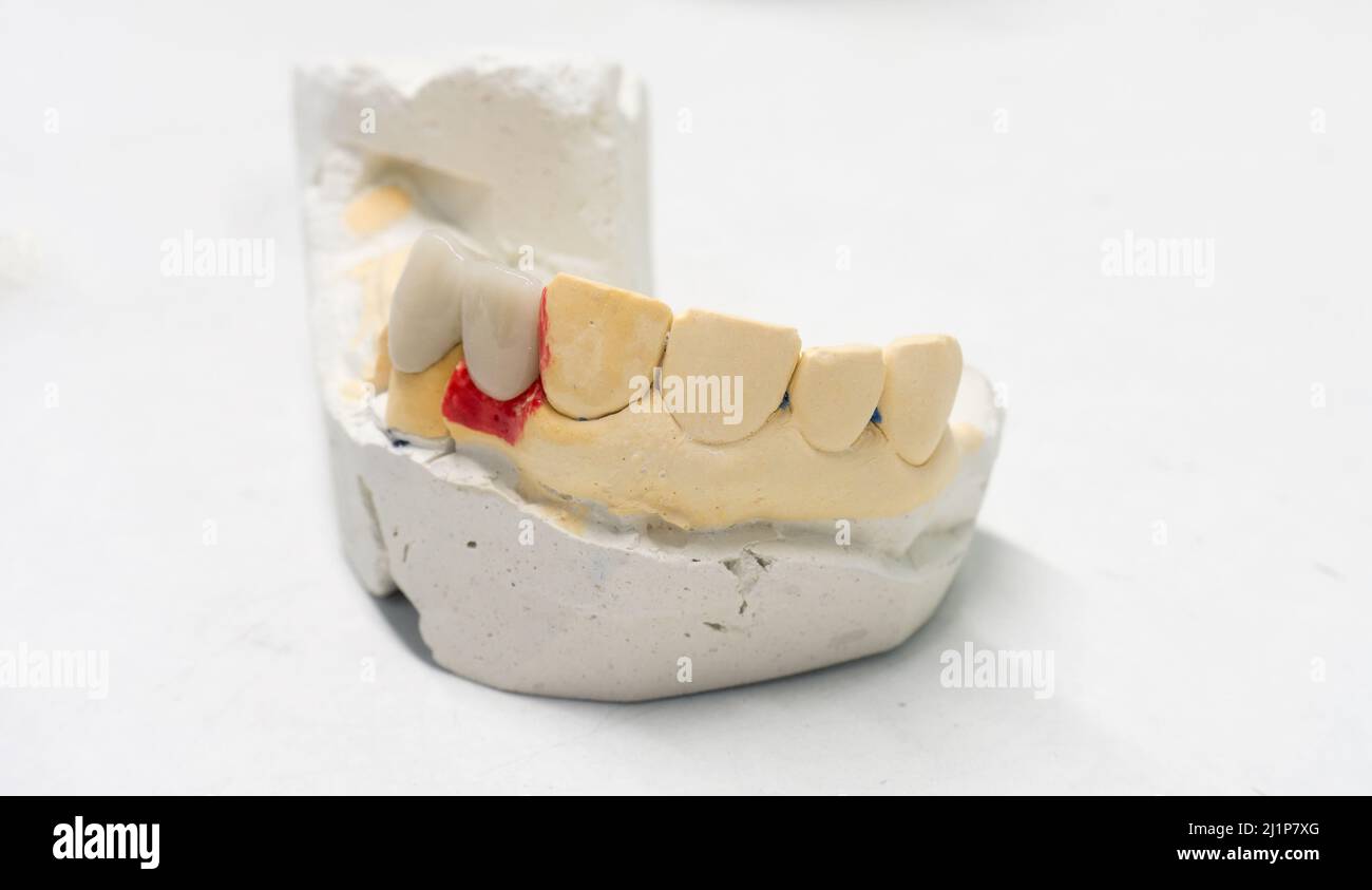 Artificial teeth are made of ceramics for the patient Stock Photo - Alamy