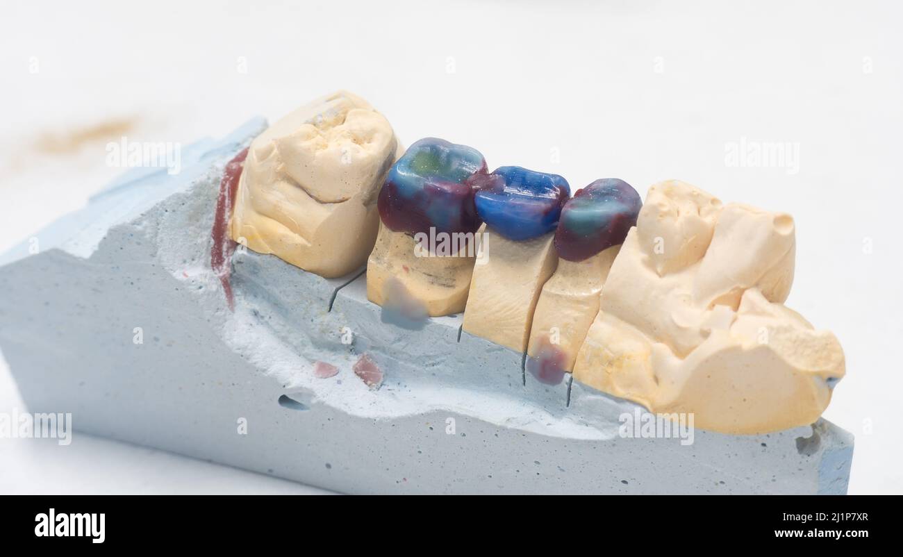 Artificial teeth are made of wax for the patient Stock Photo - Alamy