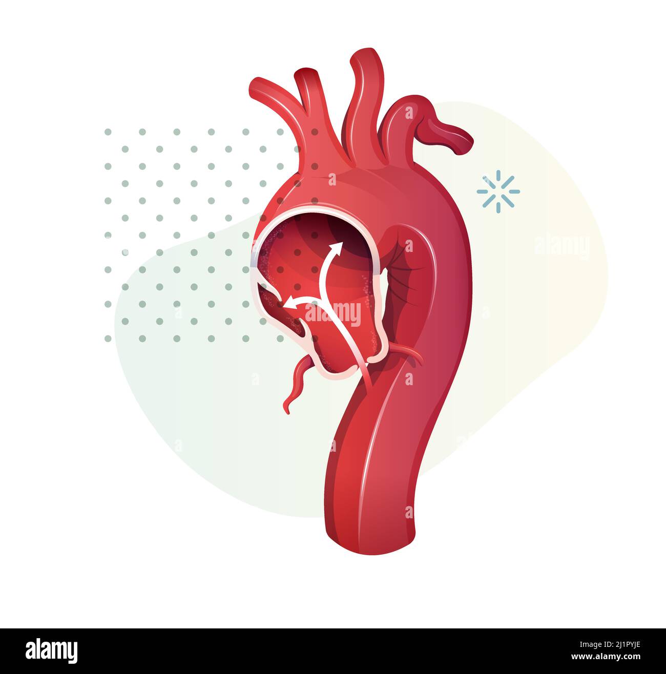 Aortic Aneurysm - Stock Illustration as EPS 10 File Stock Vector Image ...