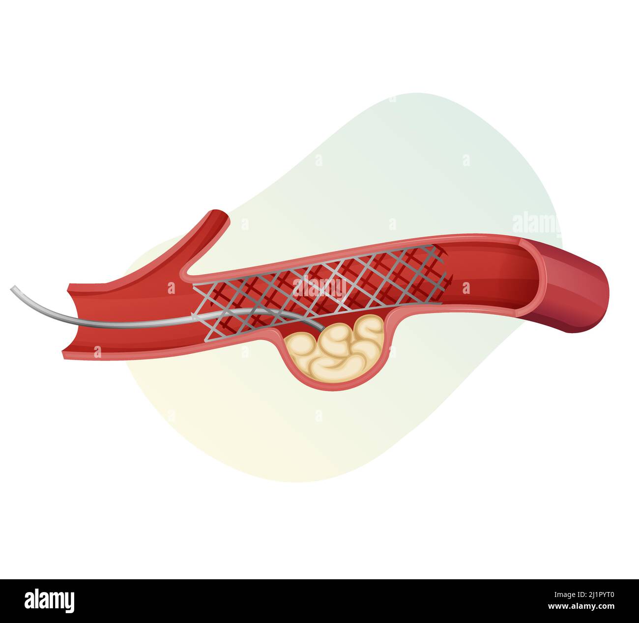 Aneurysm with Vascular Stent Procedure - Stock Illustration as EPS 10 ...