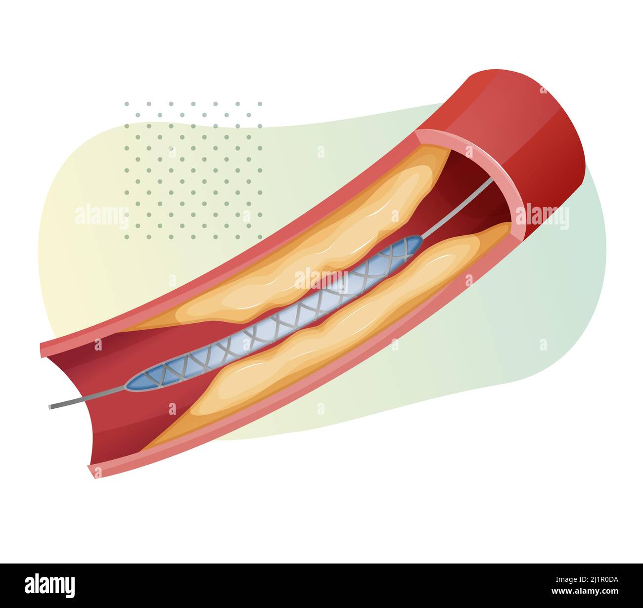 Heart Stent Procedure - Stock Illustration as EPS 10 File Stock Vector ...