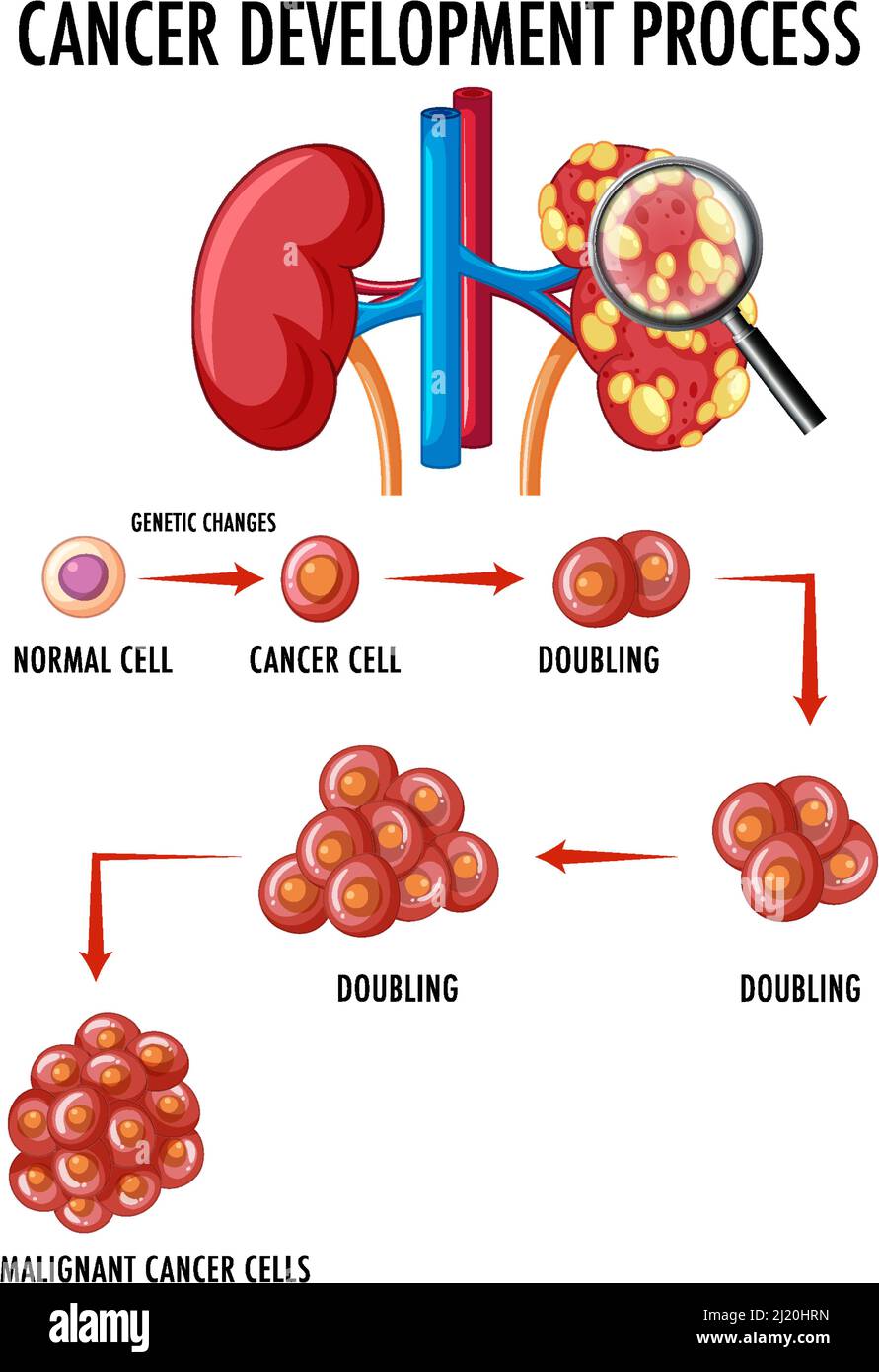 Diagram showing cancer development process illustration Stock Vector ...