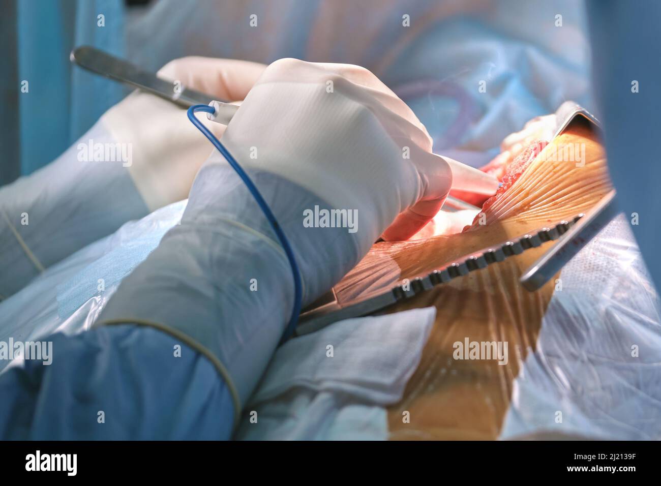 Closeup of professional doctor hands operating a patient during open ...