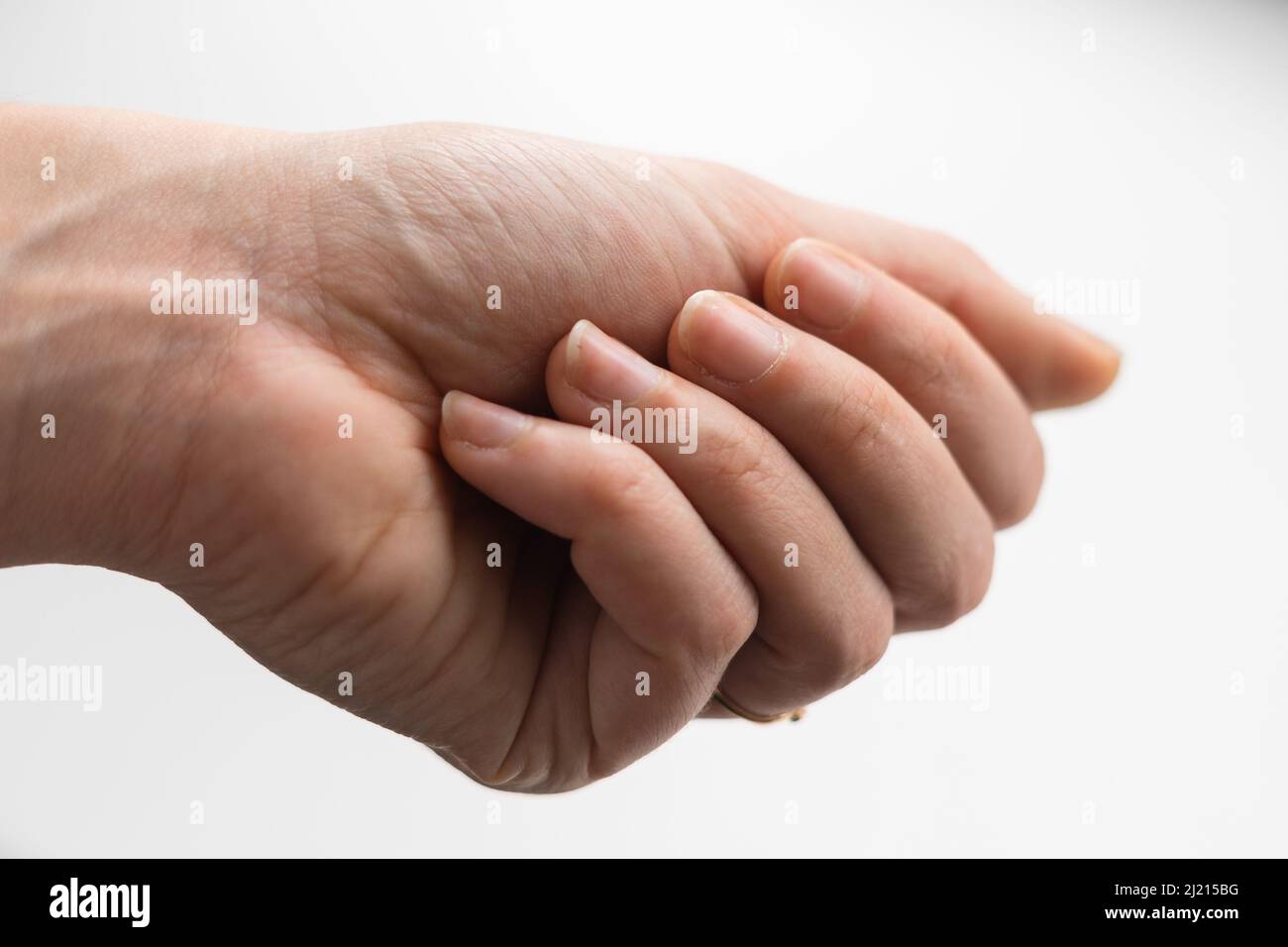 Close up of brittle nails on woman hand. White background. Brocken and ...