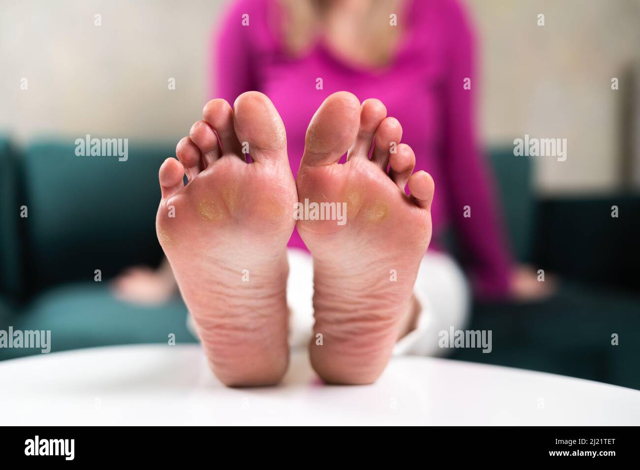 Close up of woman legs with callus on it. Feet with corn caused of ...