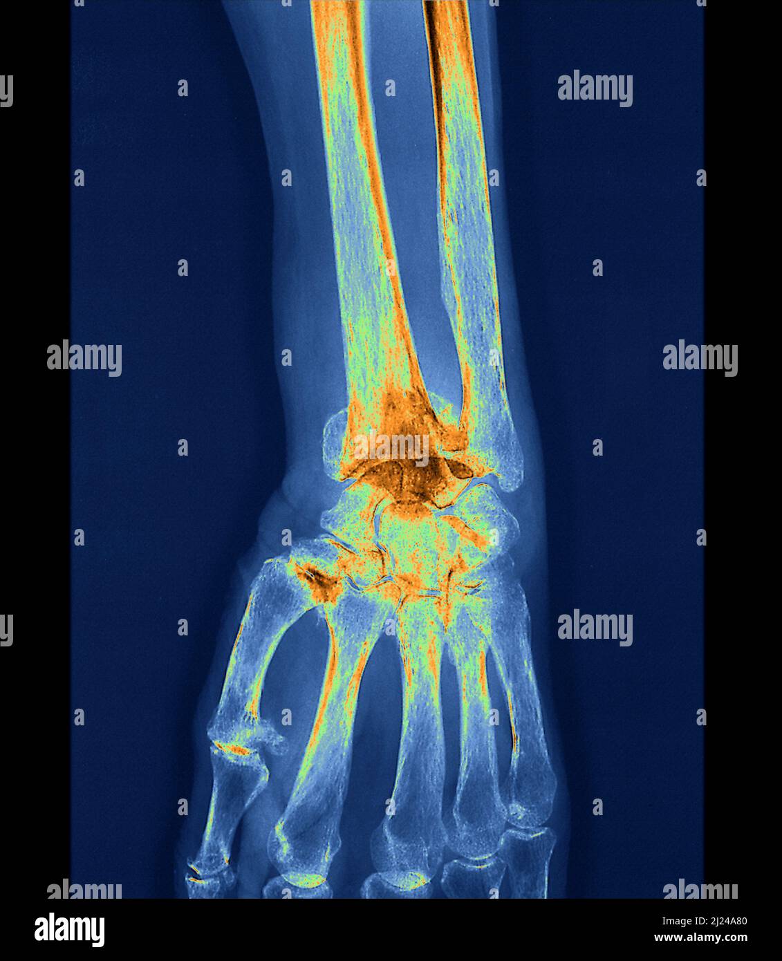 Fractured left wrist, X-ray Stock Photo - Alamy