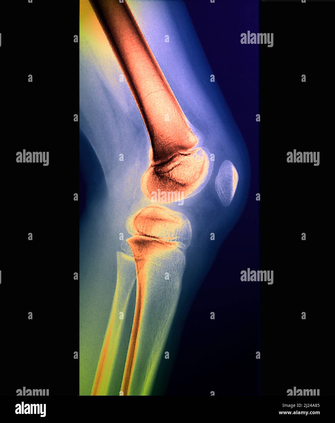 Healthy knee of a child, X-ray Stock Photo - Alamy