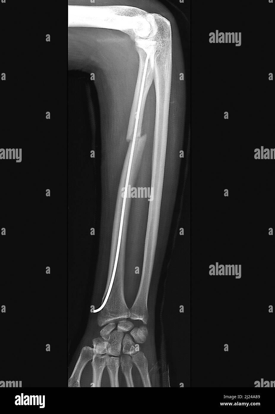Pinned fractured radius arm bone, X-ray Stock Photo - Alamy