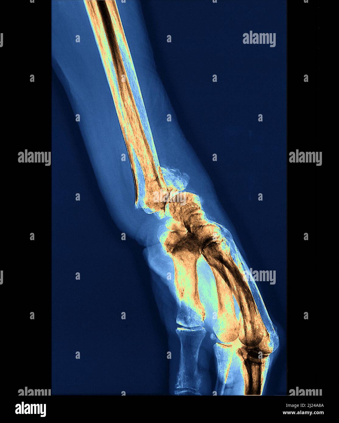 Wrist fracture, X-ray Stock Photo - Alamy