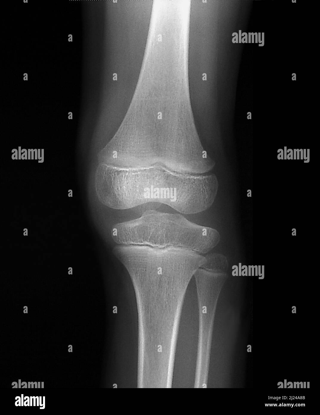 Normal knee of a child, X-ray Stock Photo - Alamy
