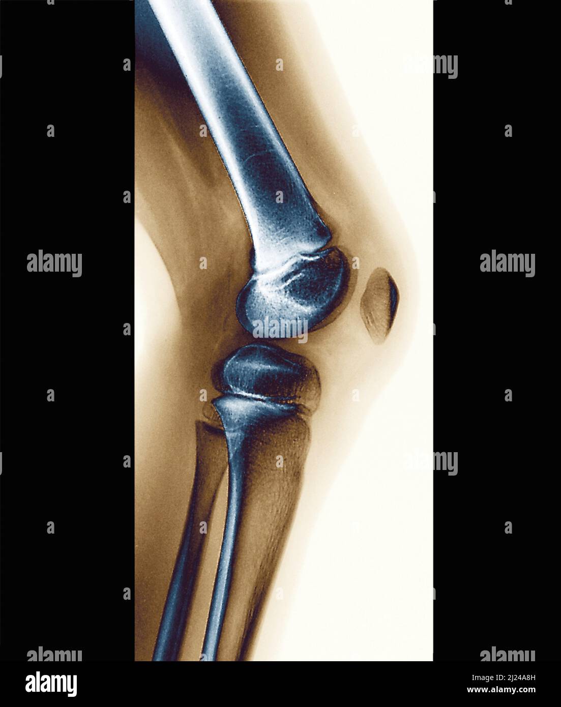 Healthy knee of a child, X-ray Stock Photo - Alamy