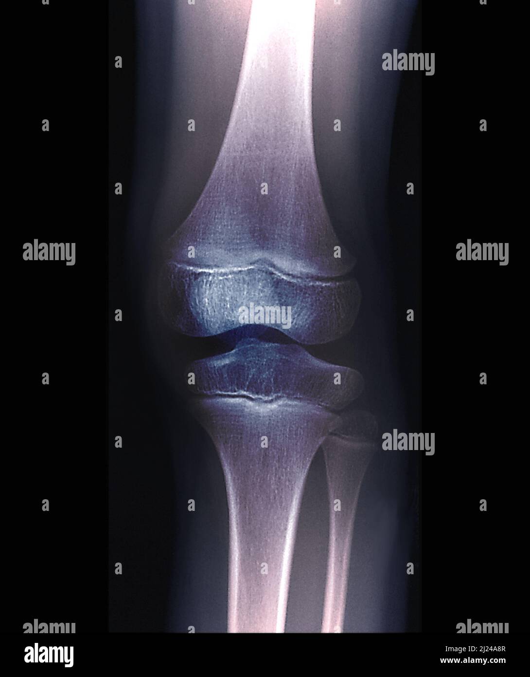Normal knee of a child, X-ray Stock Photo - Alamy