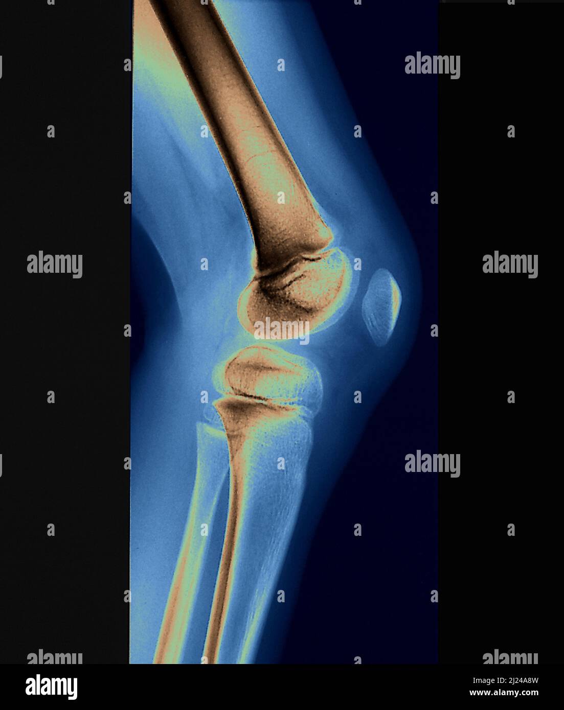 Healthy knee of a child, X-ray Stock Photo - Alamy
