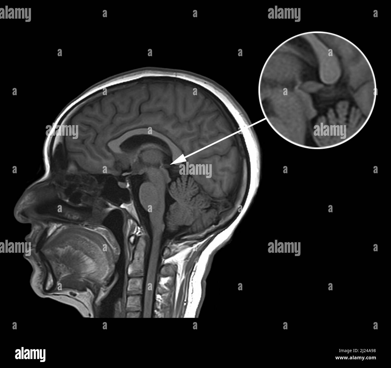 Healthy pineal gland, MRI scan Stock Photo - Alamy