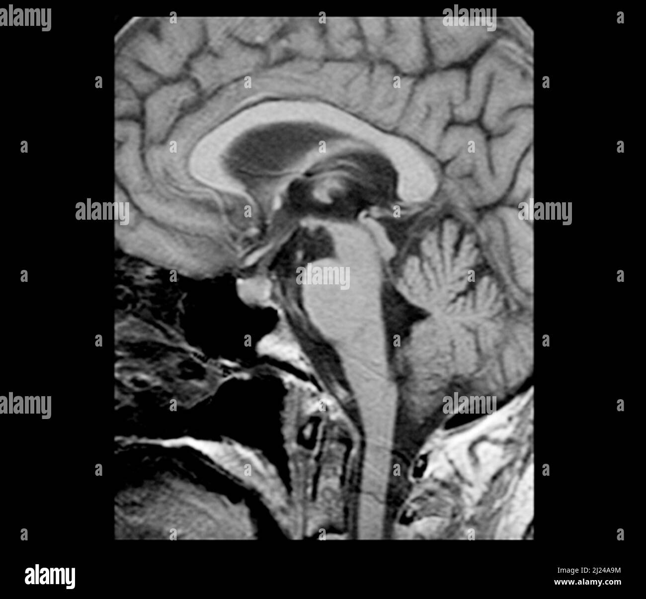 Healthy midbrain, MRI scan Stock Photo - Alamy