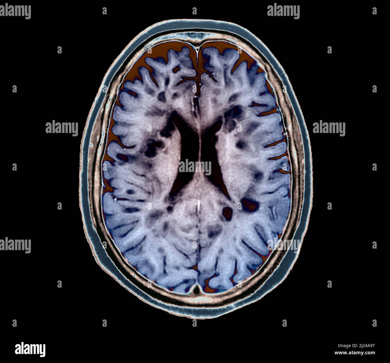 Multiple sclerosis, MRI scan Stock Photo - Alamy