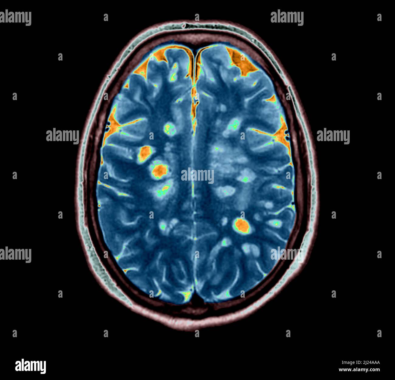 Multiple sclerosis, MRI scan Stock Photo - Alamy