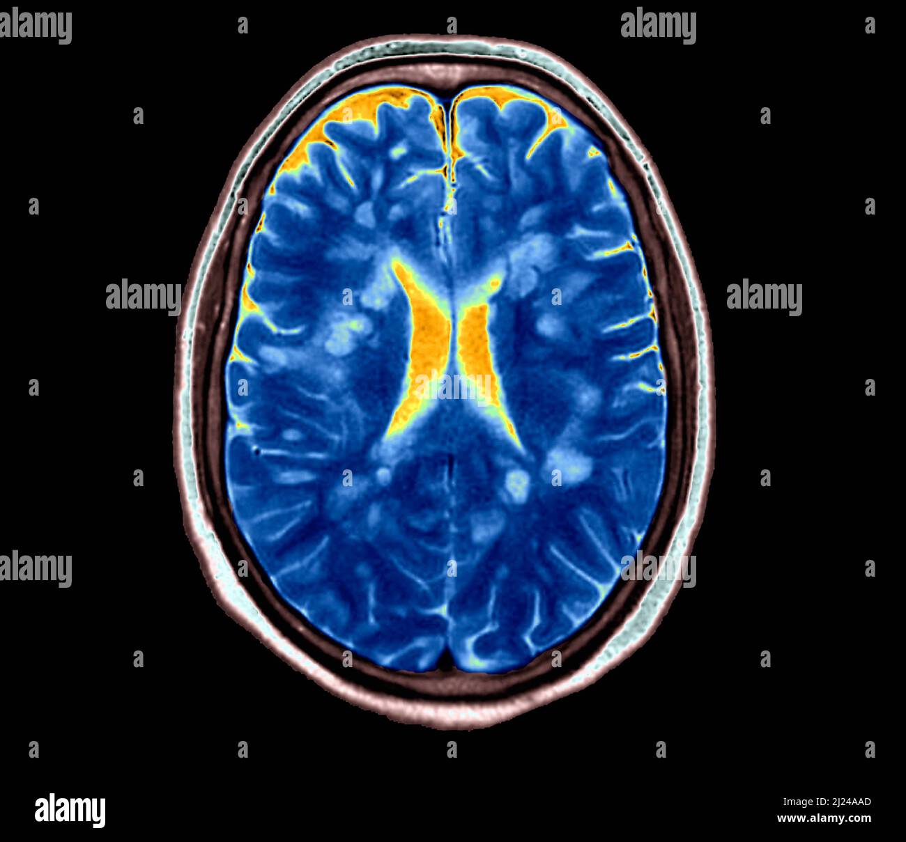Multiple sclerosis, MRI scan Stock Photo - Alamy