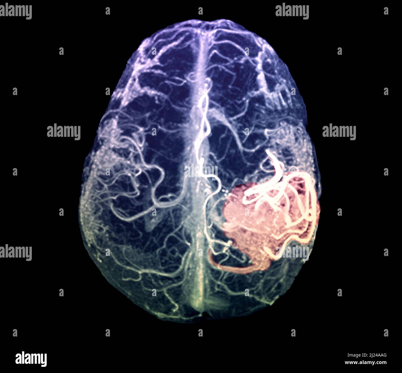 Arteriovenous malformation, MRI scan Stock Photo - Alamy