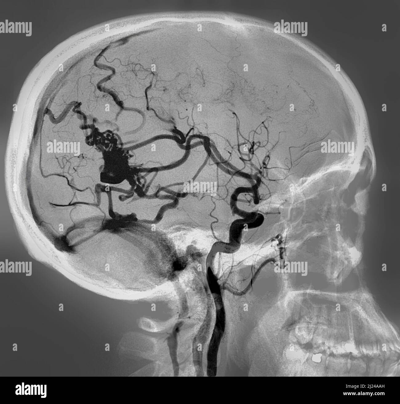 Arteriovenous malformation, CT angiogram Stock Photo - Alamy