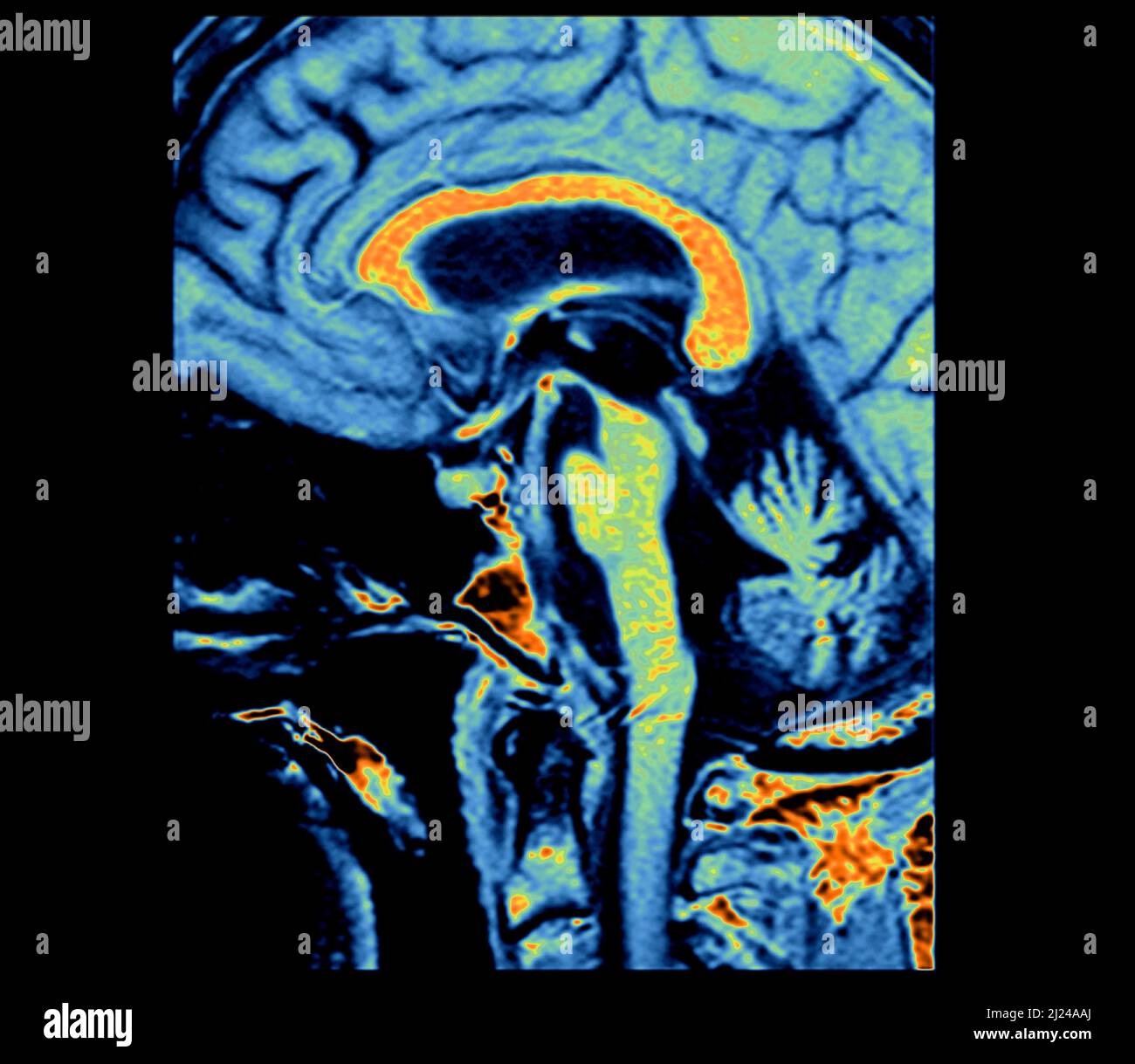 Progressive supranuclear palsy, MRI scan Stock Photo - Alamy