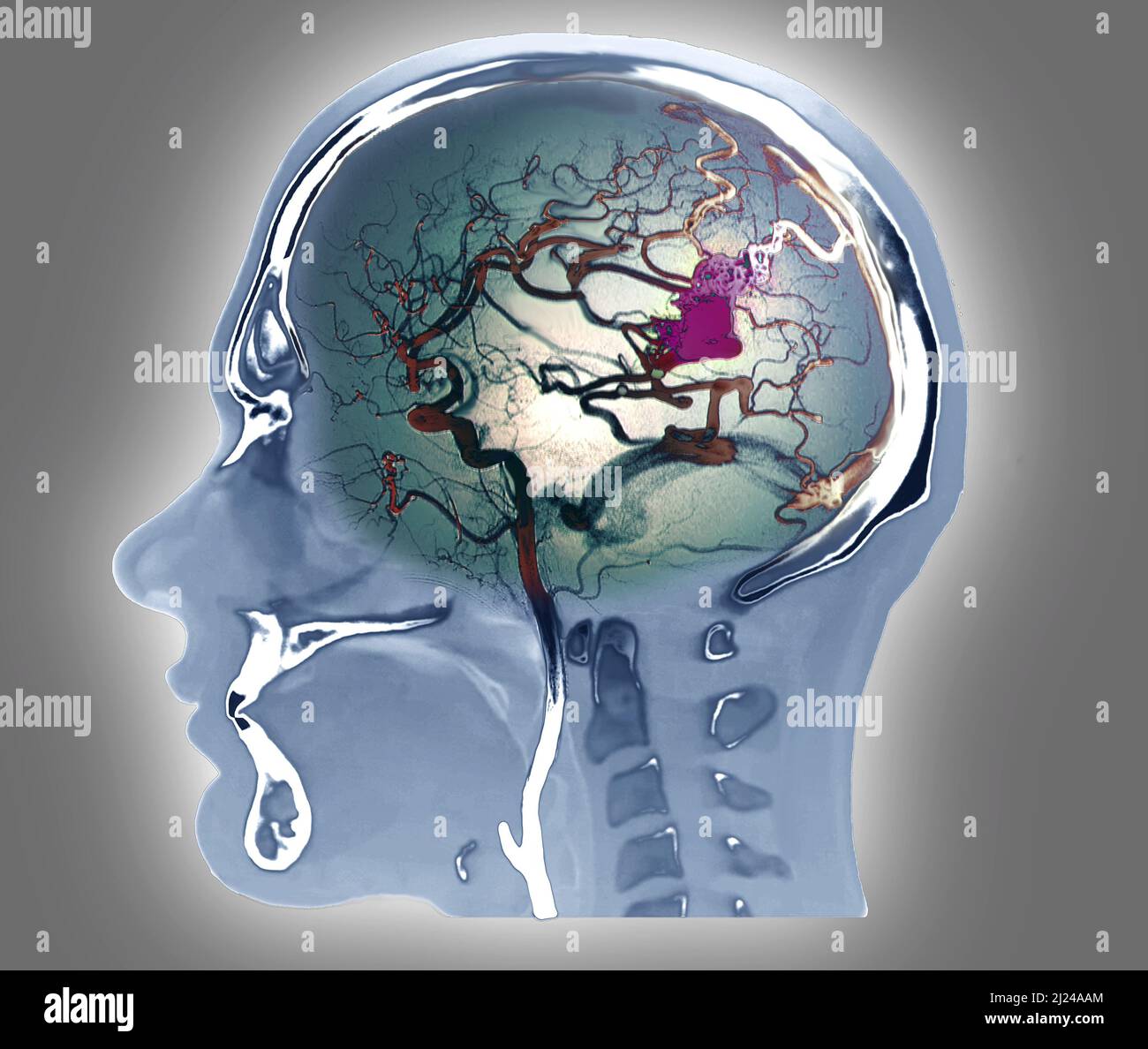 Arteriovenous malformation, CT angiogram Stock Photo - Alamy