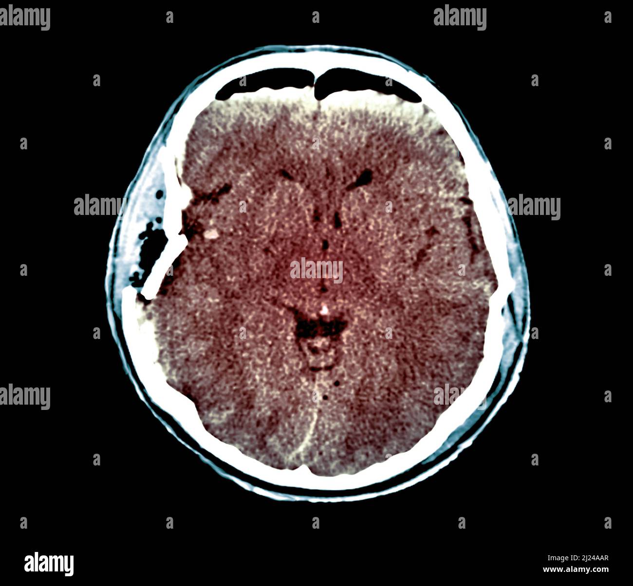 Traumatic brain injury, CT scan Stock Photo - Alamy