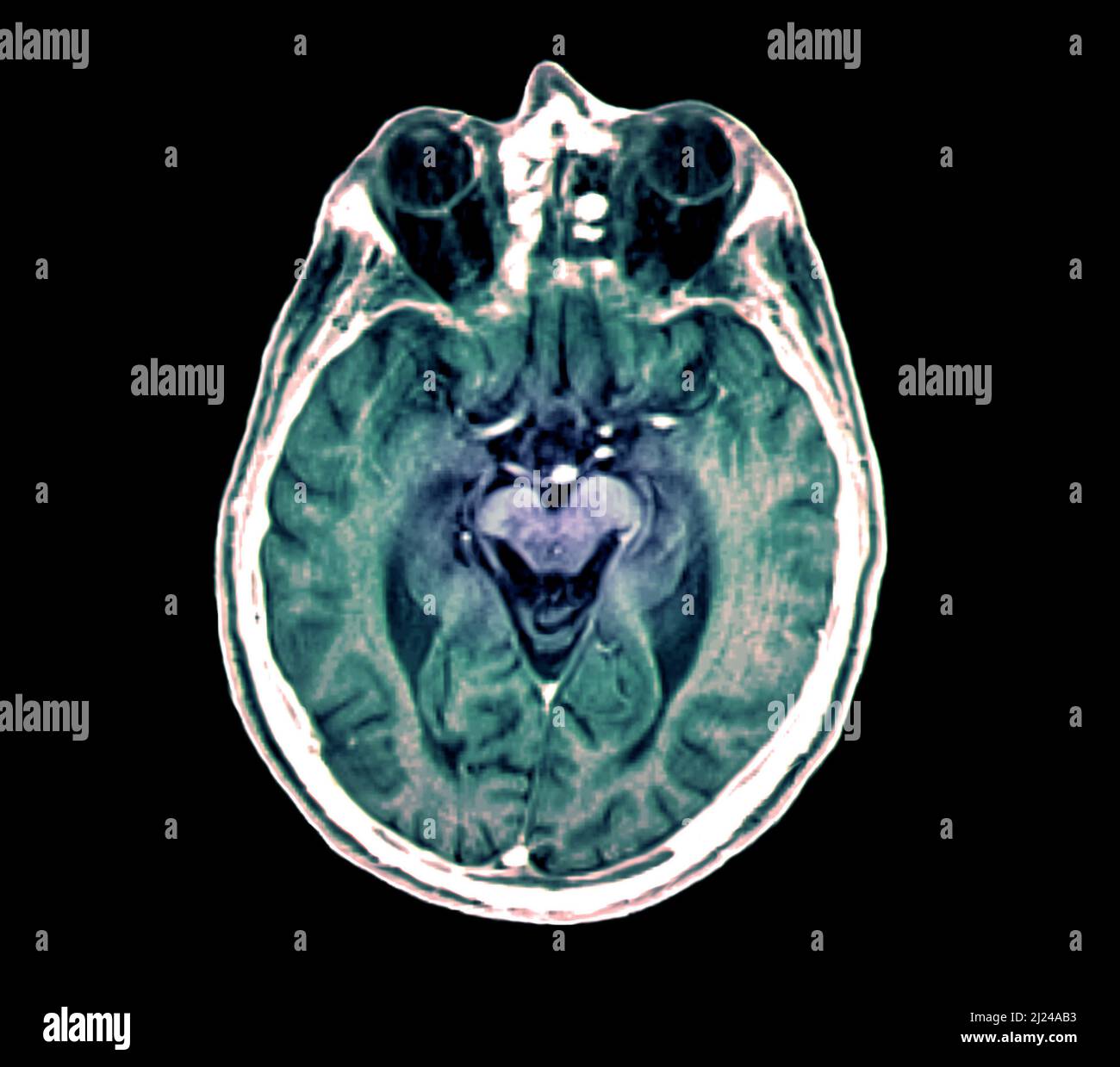 Cerebral atrophy, illustration Stock Photo - Alamy