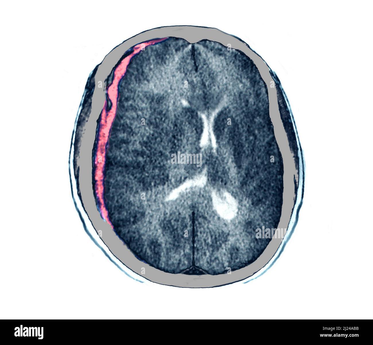 Subdural haematoma, CT scan Stock Photo - Alamy