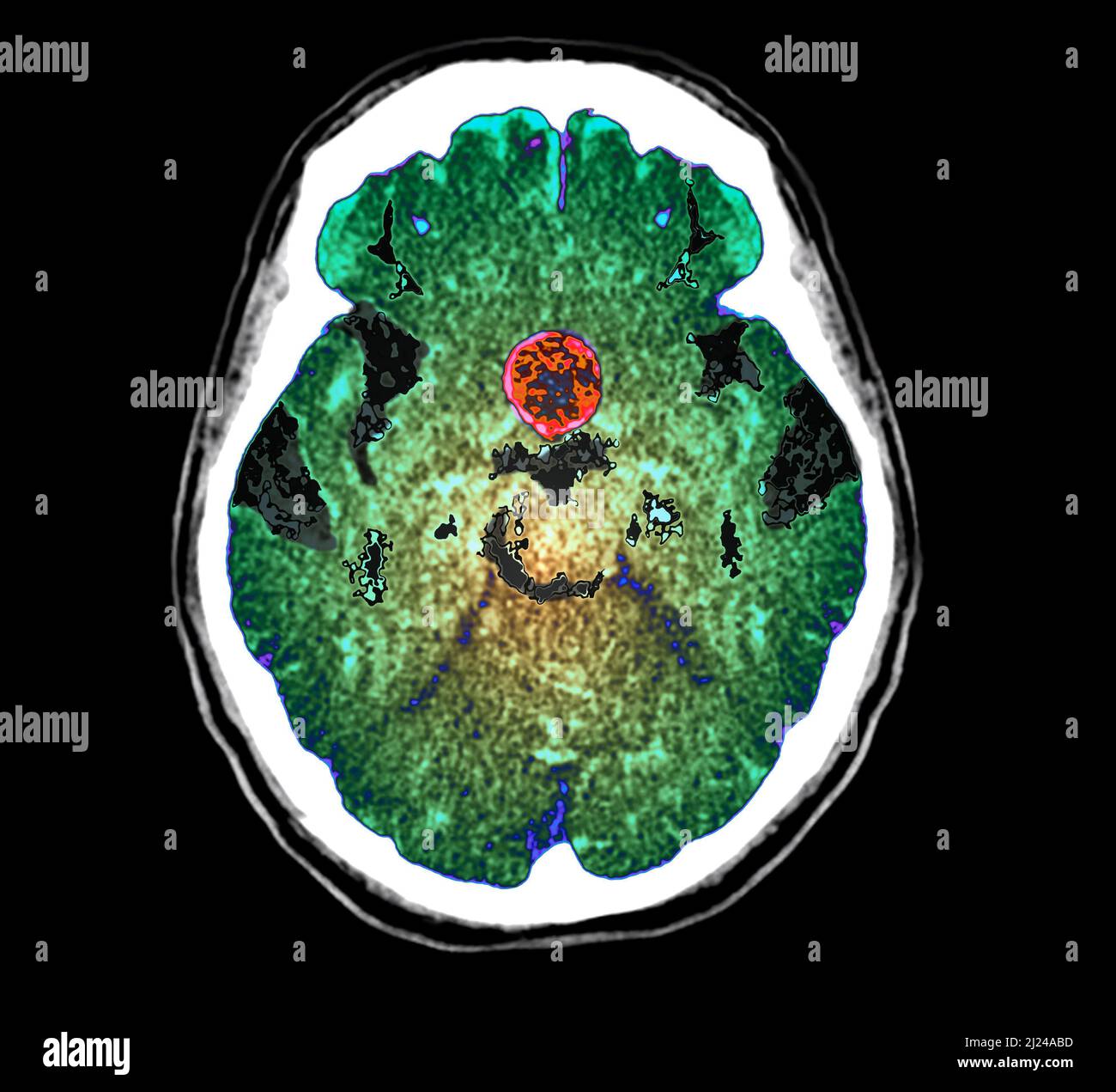 Suprasellar aneurysm, CT scan Stock Photo - Alamy