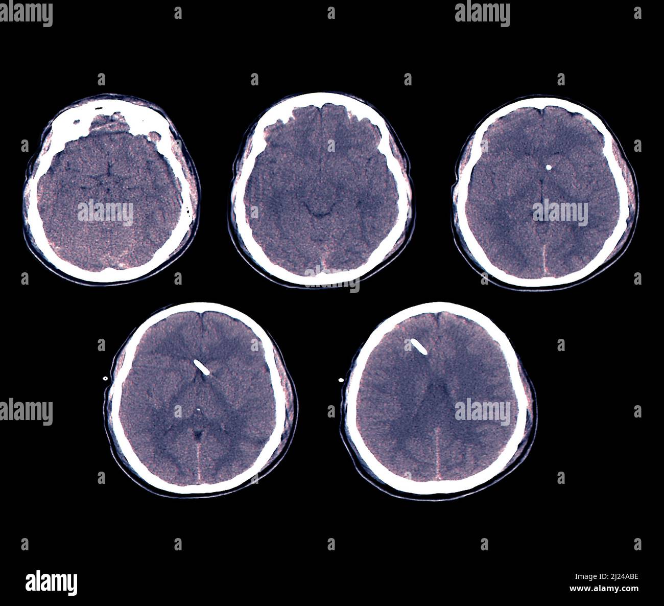 Cerebral oedema, CT scan Stock Photo - Alamy