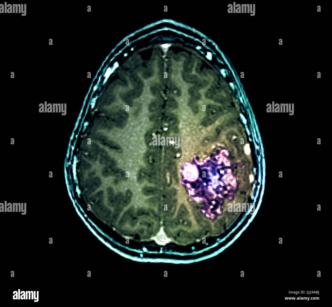 Arteriovenous malformation, MRI scan Stock Photo - Alamy
