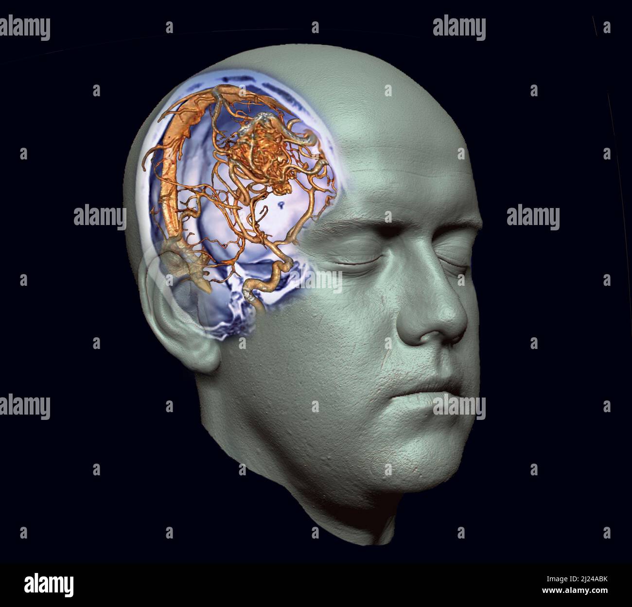 Arteriovenous malformation, CT angiogram Stock Photo - Alamy