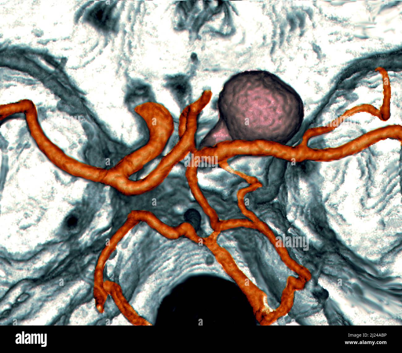 Subarachnoid hemorrhage, CT angiogram Stock Photo - Alamy