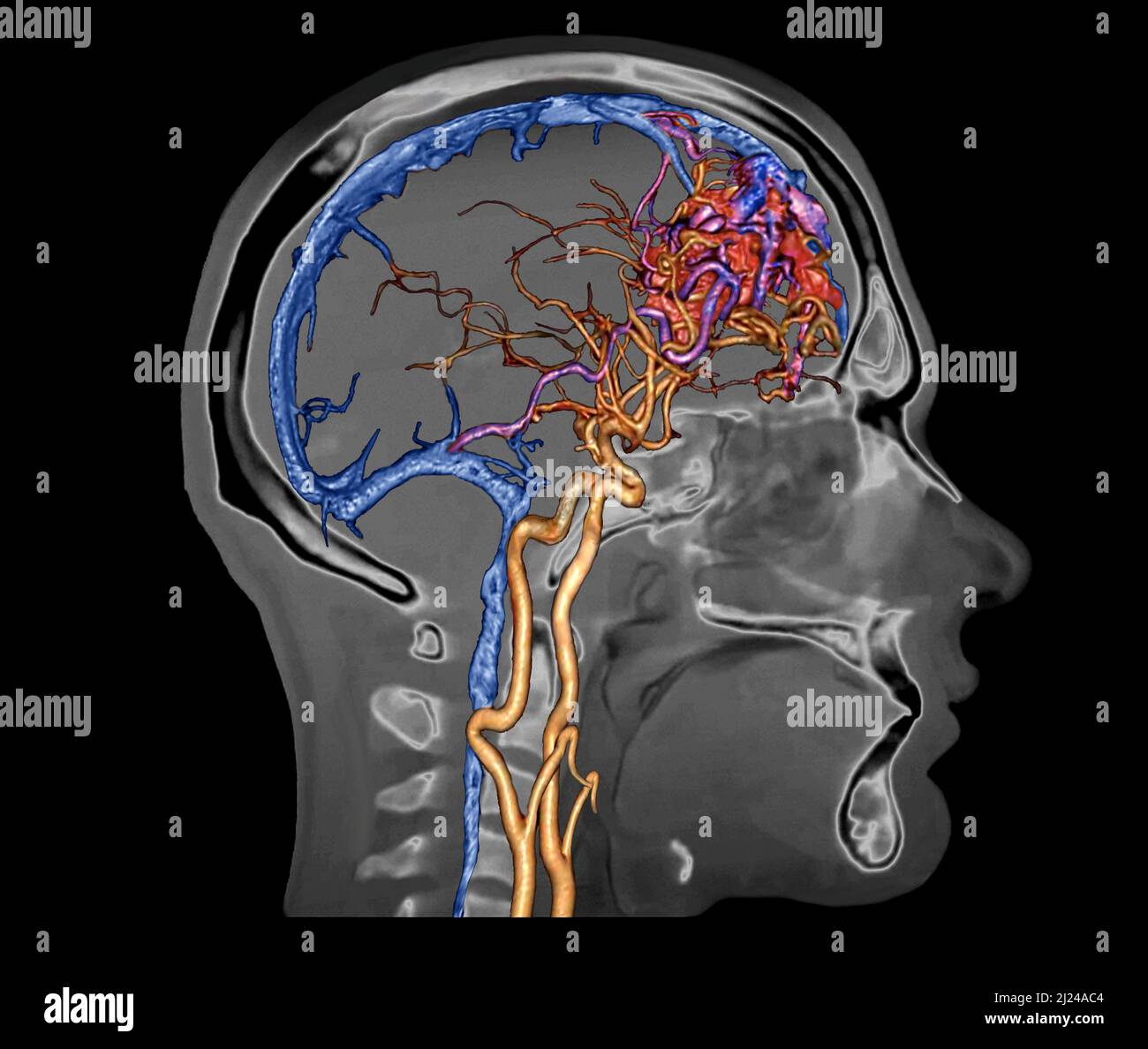 Arteriovenous malformation, CT angiogram Stock Photo - Alamy