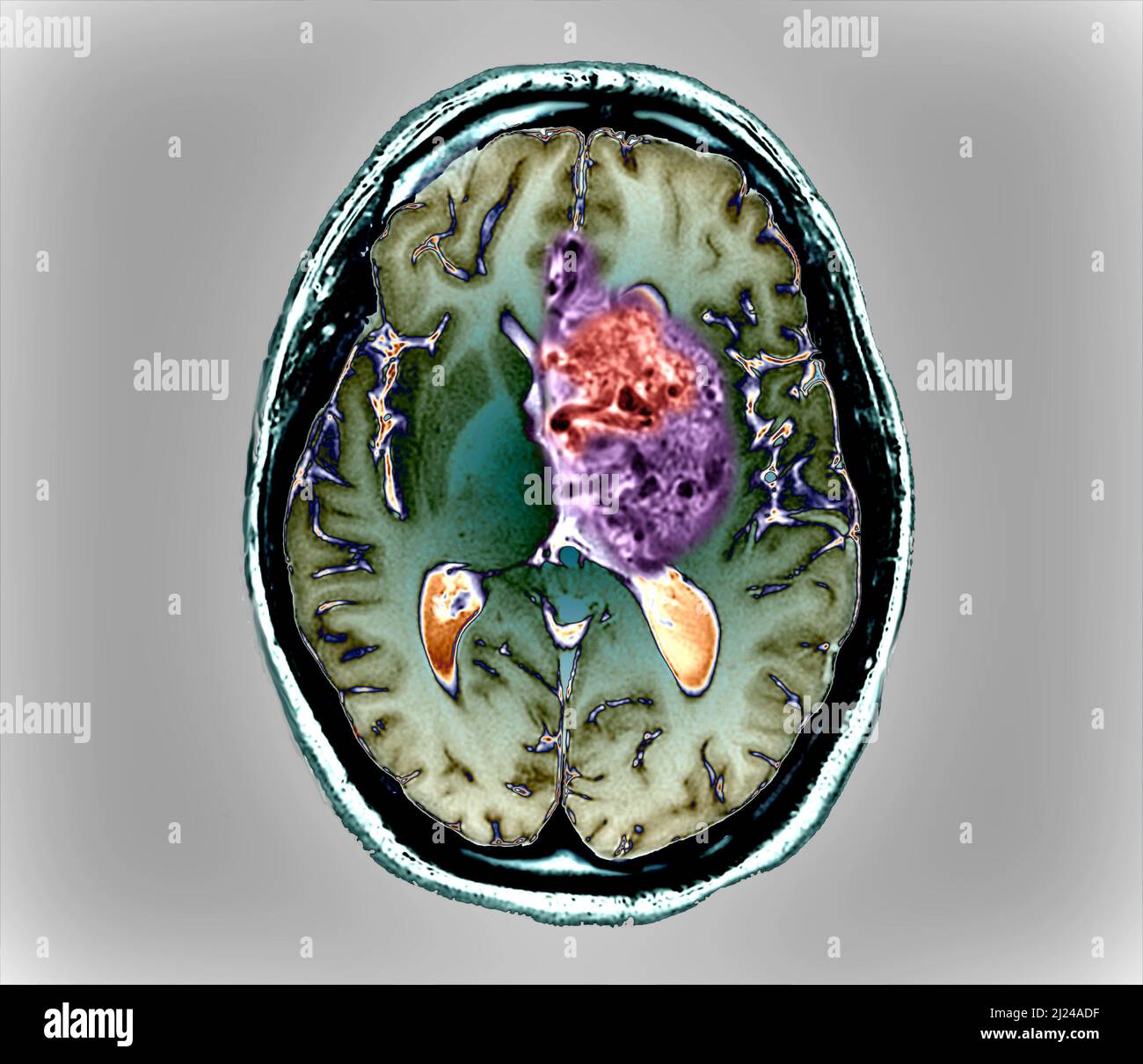 Subarachnoid hemorrhage, MRI scan Stock Photo - Alamy