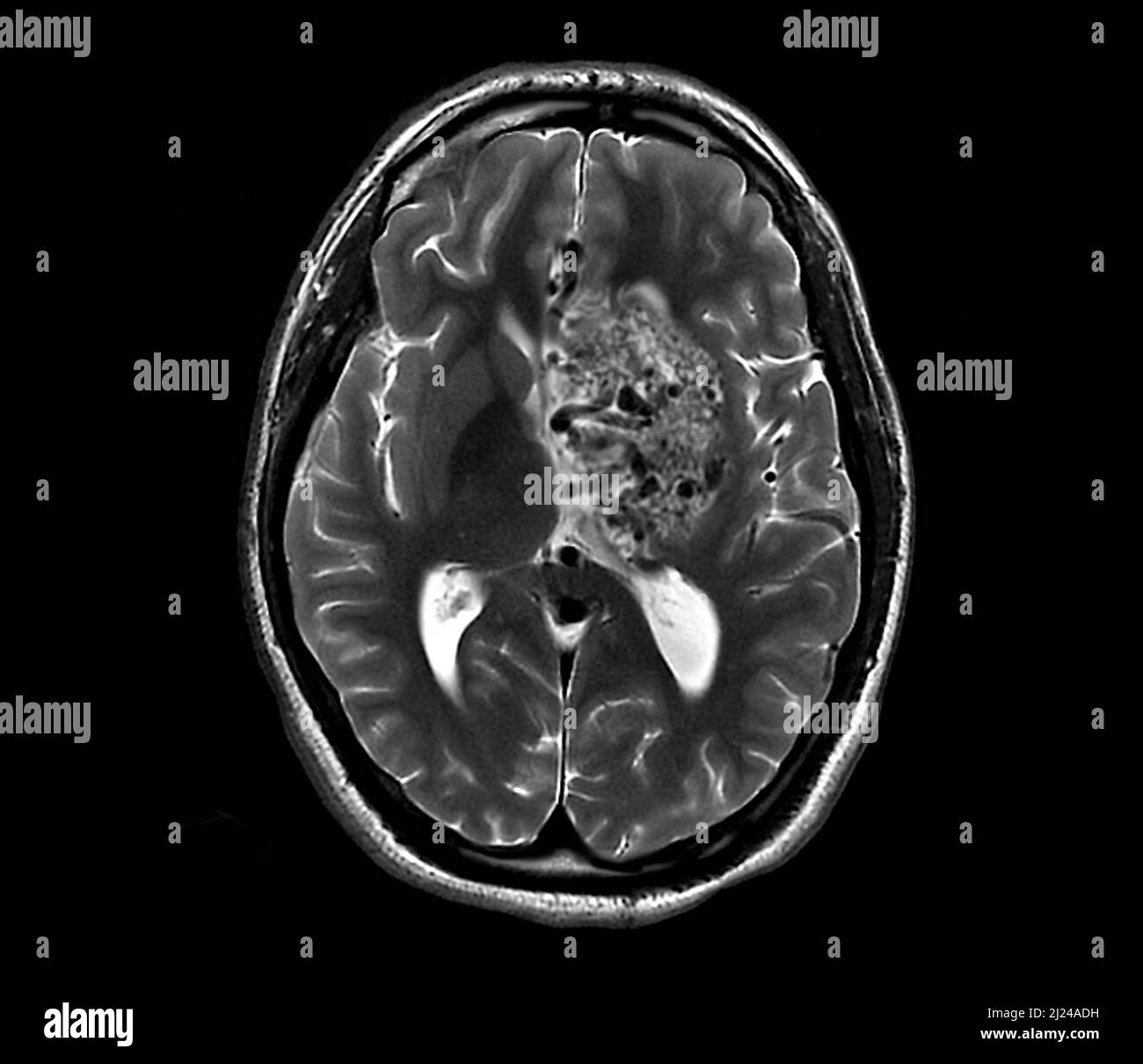 Subarachnoid hemorrhage, MRI scan Stock Photo - Alamy