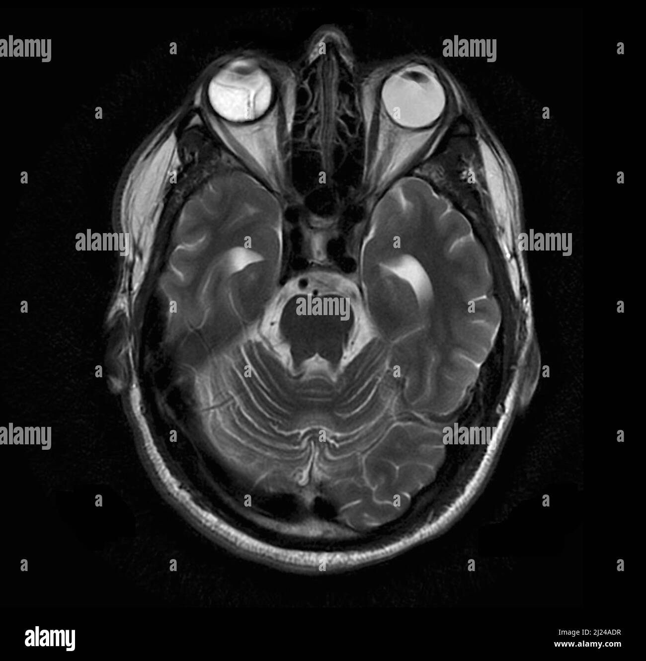 Retinal detachment, MRI scan Stock Photo - Alamy