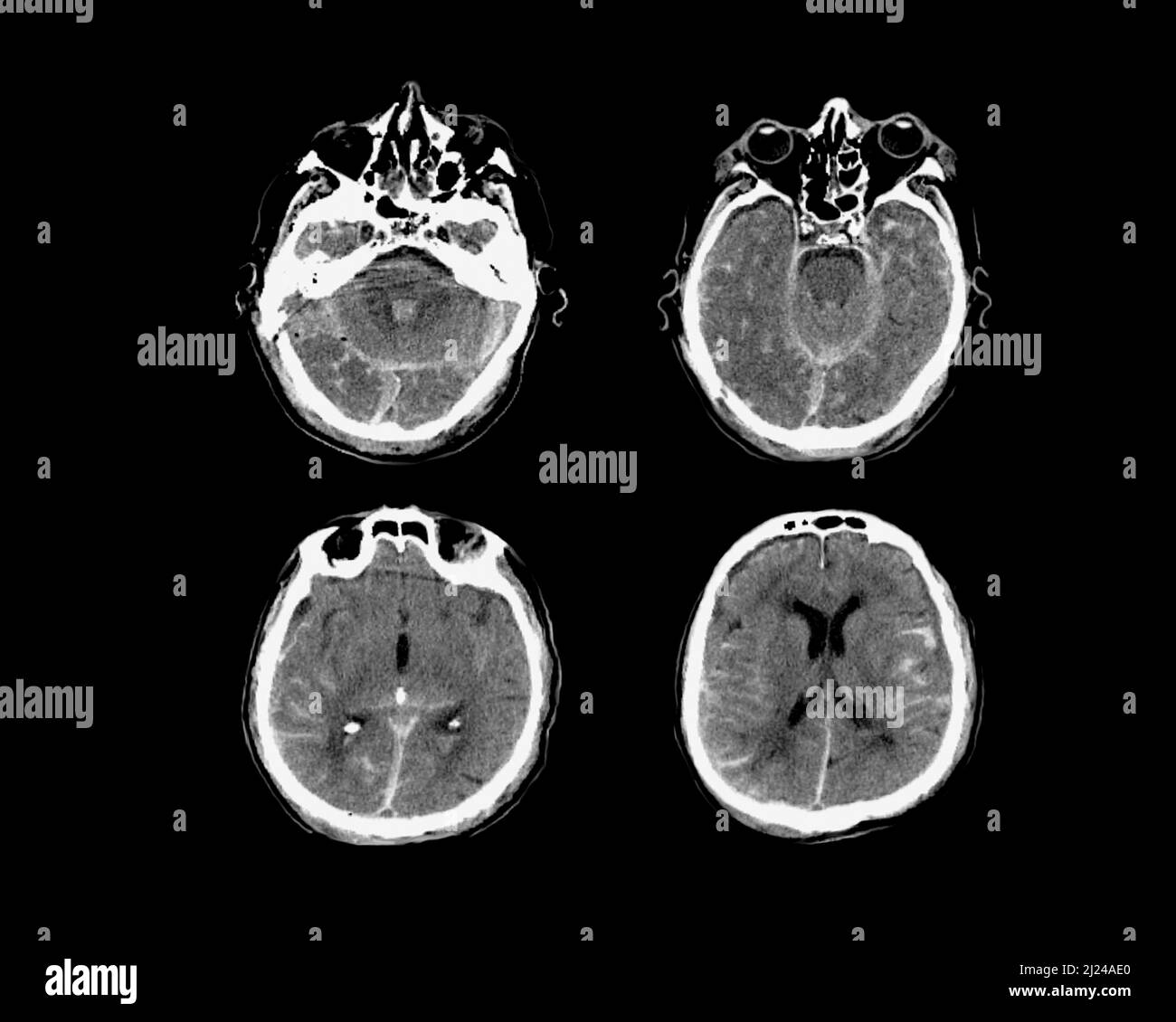 Brain haemorrhage, CT scans Stock Photo - Alamy