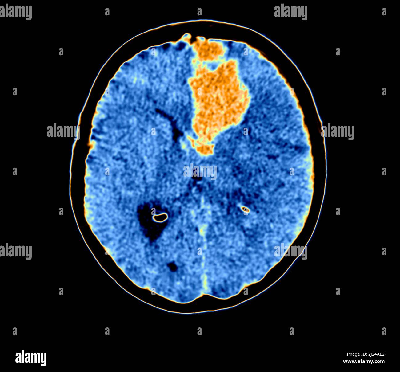 Brain haemorrhage, CT scan Stock Photo - Alamy