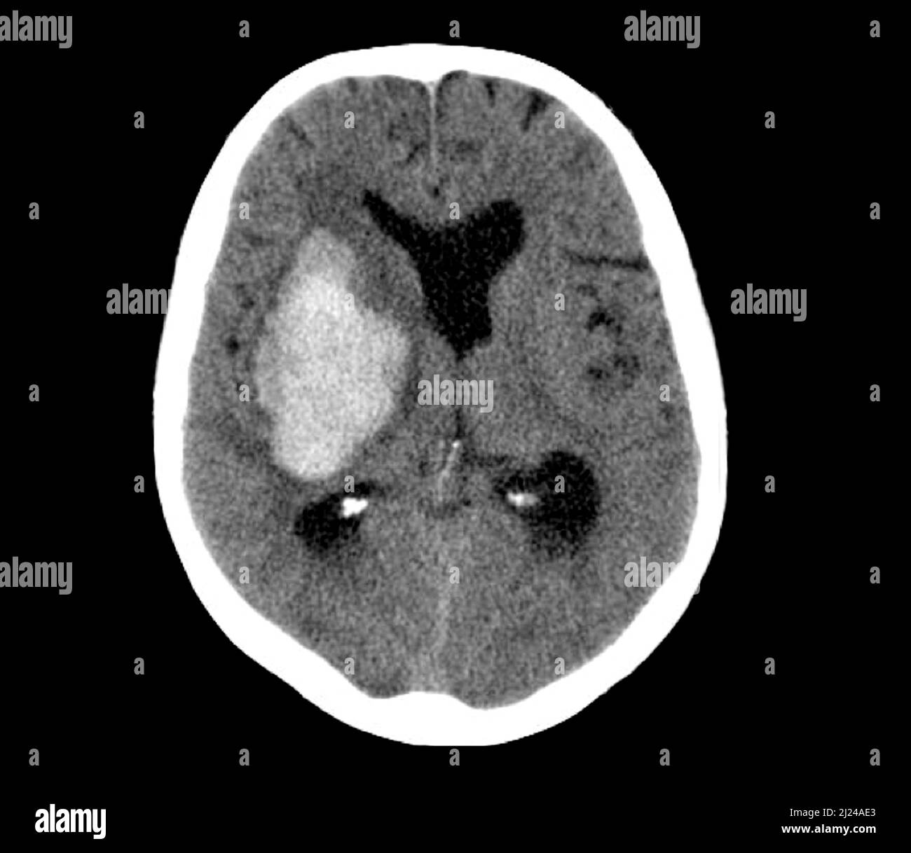 Cerebral haemorrhage, CT scan Stock Photo - Alamy