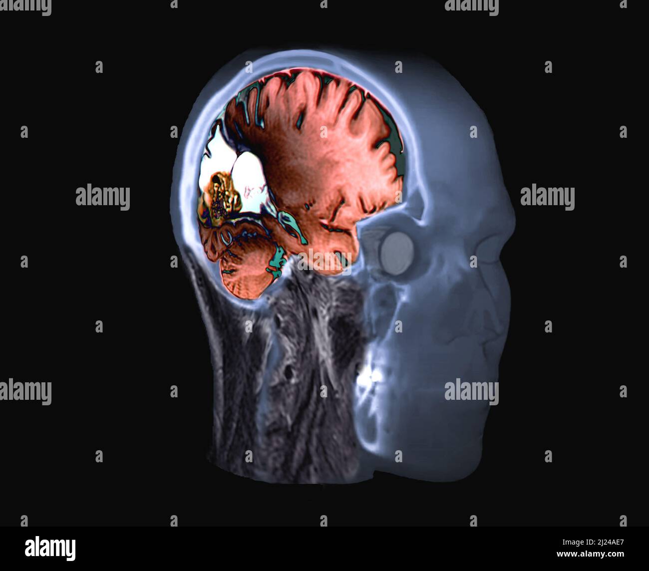 Arteriovenous malformation, composite MRI and 3D CT scan Stock Photo - Alamy